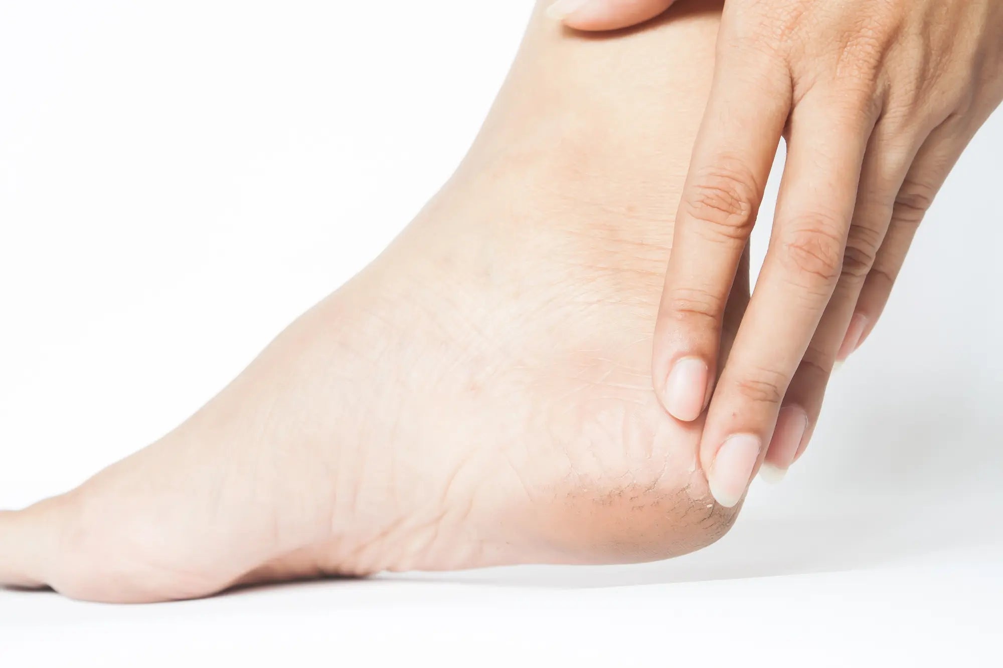 Effective Foot Callus Treatment & Prevention Tips | Efforest – EFFOREST